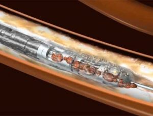 Video: Atherectomy with Jetstream from Boston Scientific